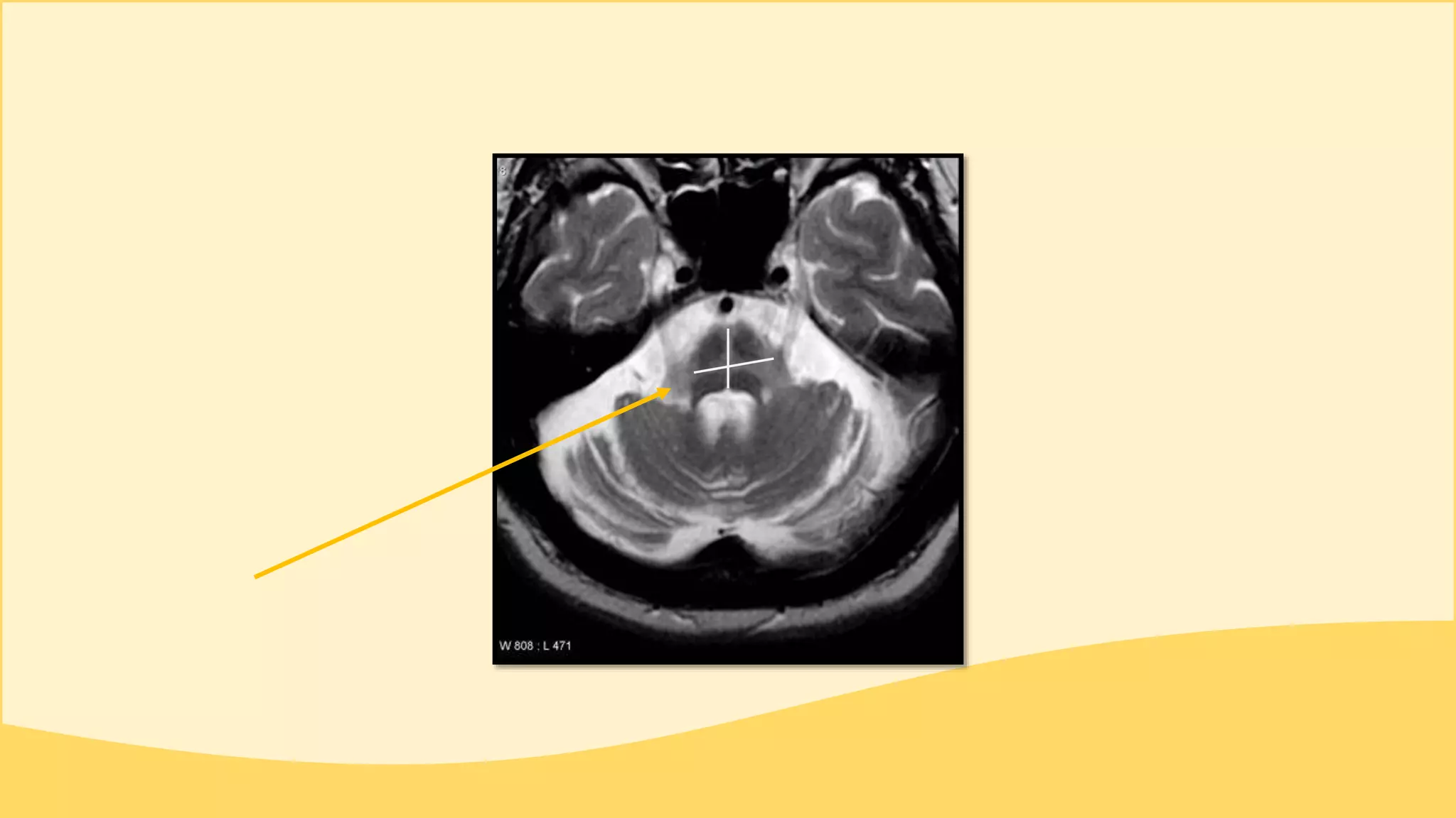 Hot cross bun appearance | PPTX
