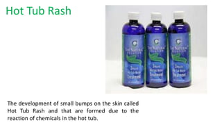 Hot Tub Rash | PPT