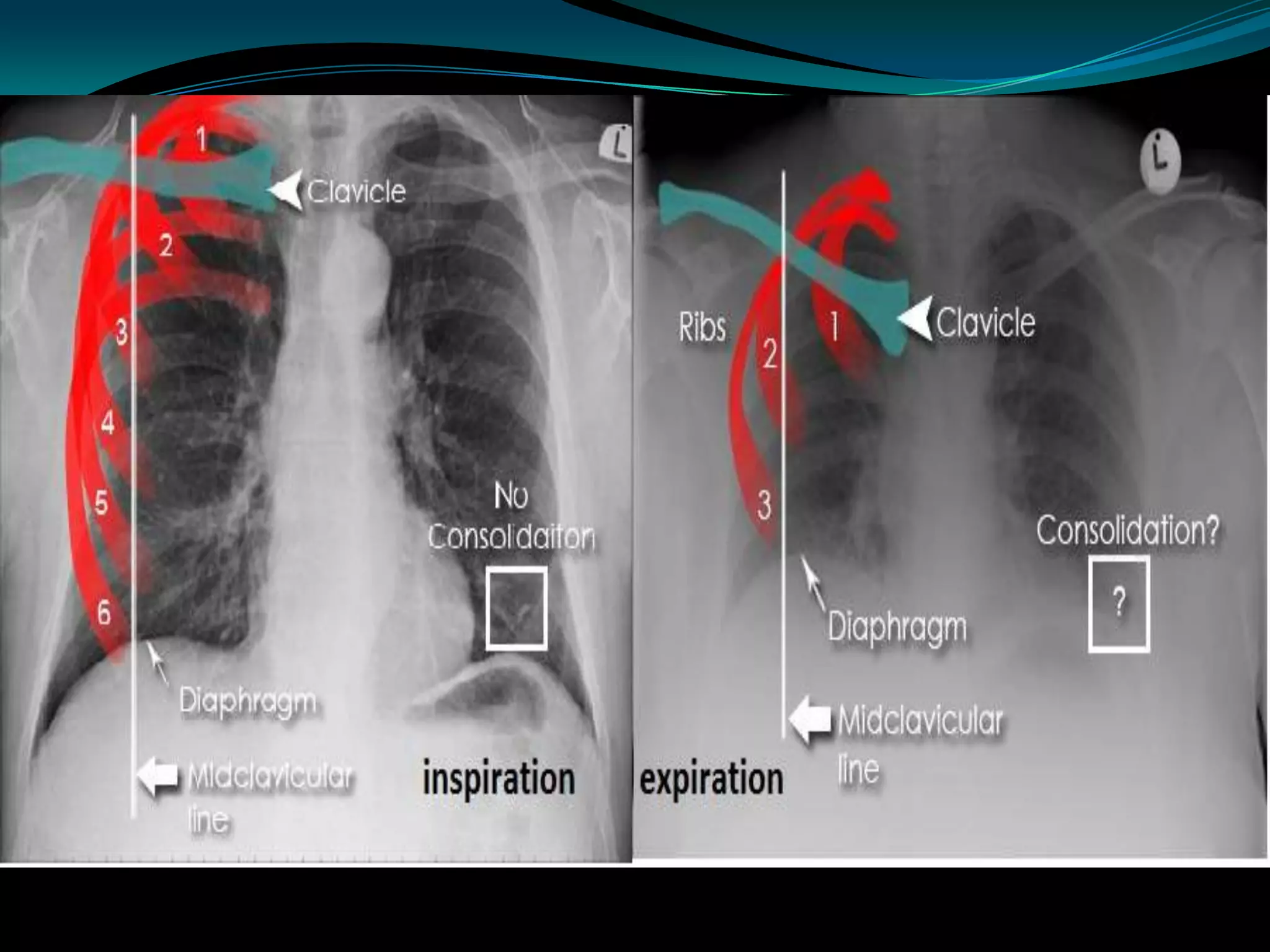 How to read normal x ray | PPTX