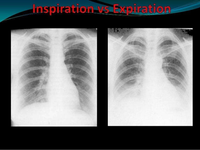 How to read normal x ray