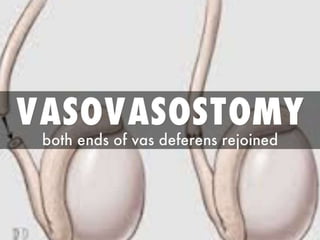 How To-Reverse-A-Vasectomy | PPTX