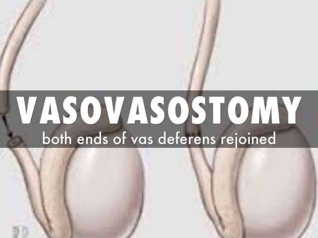 How To-Reverse-A-Vasectomy | PPTX