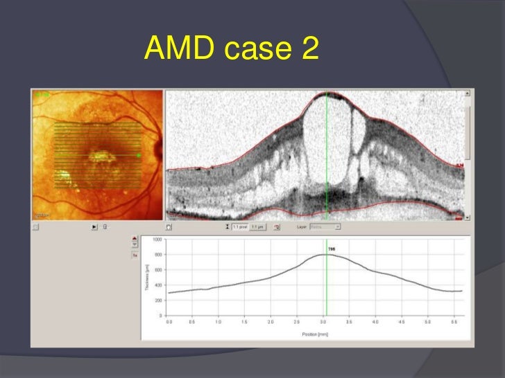 How 3 d oct enhances amd & dme treatment