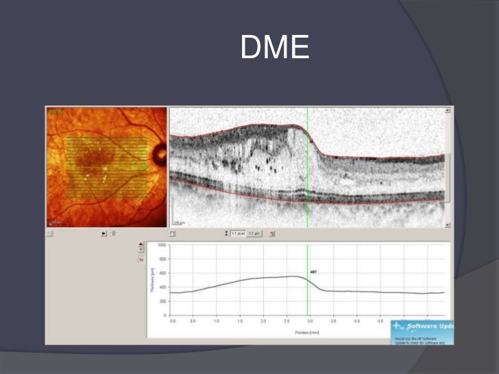 How 3 d oct enhances amd & dme treatment