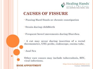 How Can You Deal With Anal Fissures | PPT
