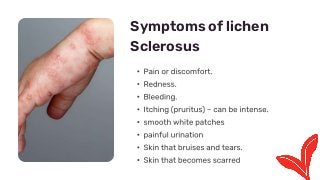 How Stem Cell Therapy Can Help With Lichen Sclerosus | Dr. David Greene ...