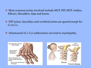 How chronic inflammation in rheumatoid arthritis affects brain pre | PPT