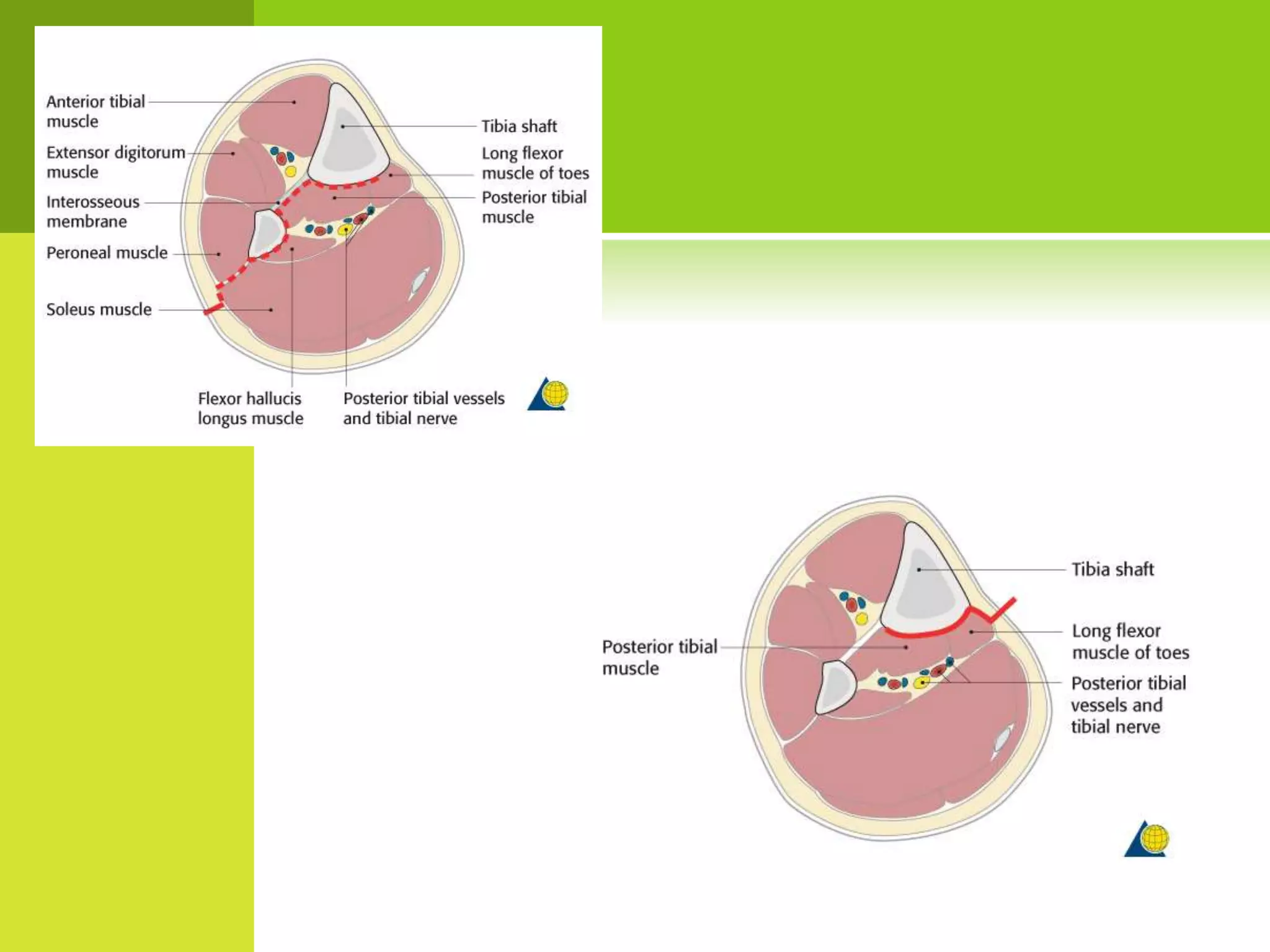How Do I Do Below Knee Amputation.pptx