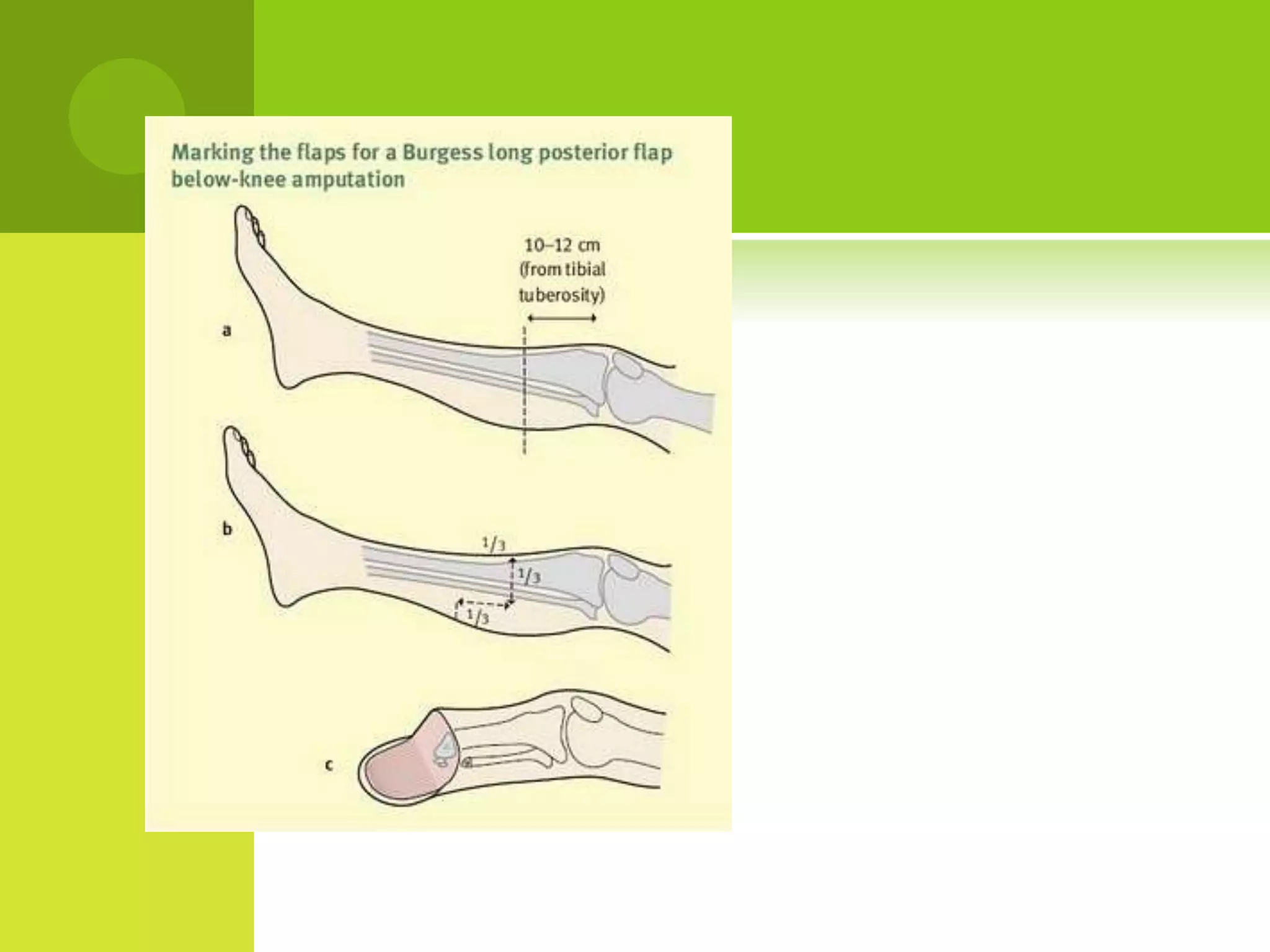 How Do I Do Below Knee Amputation.pptx