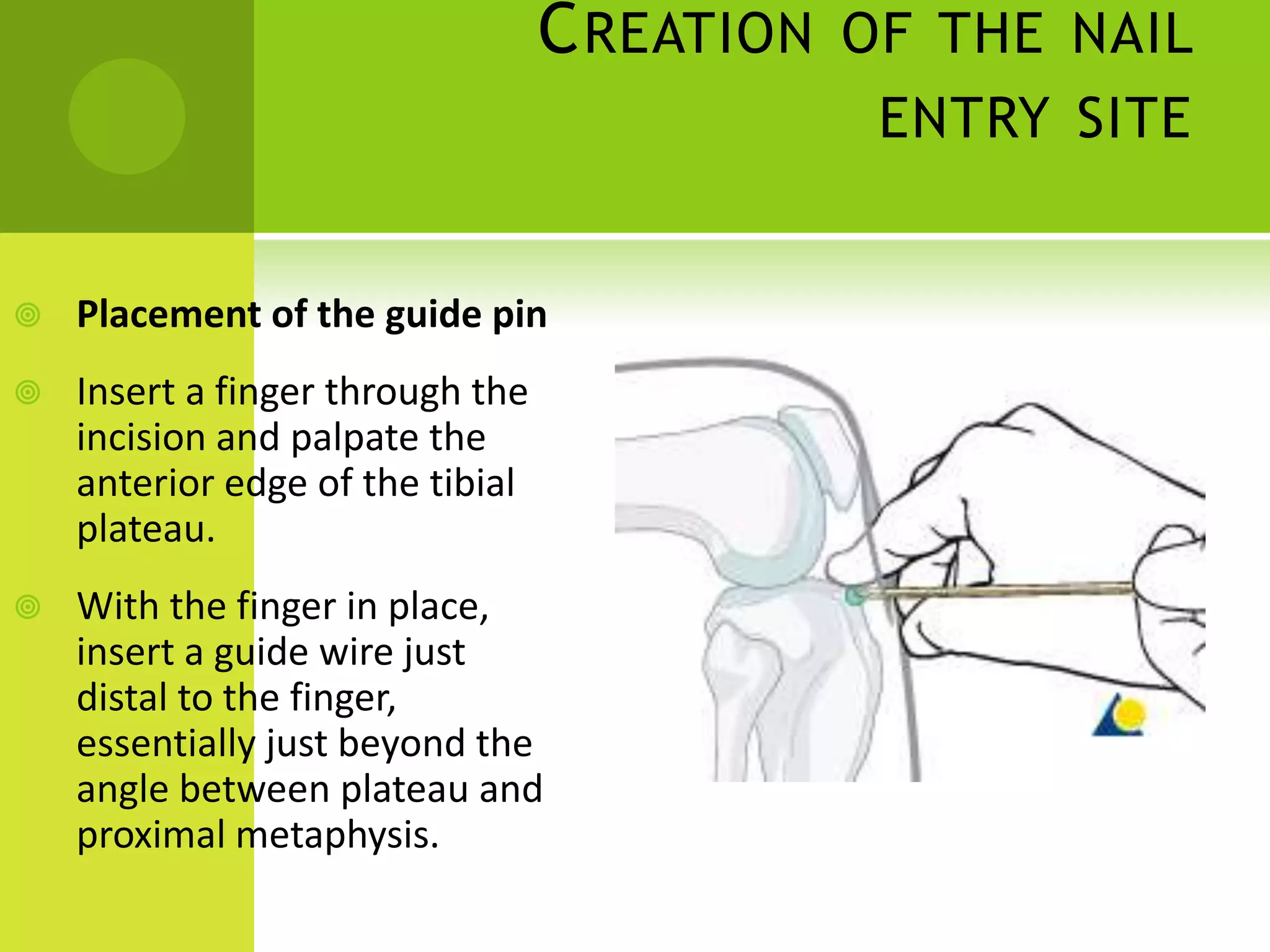 How do I do Interlocking Tibia.pptx