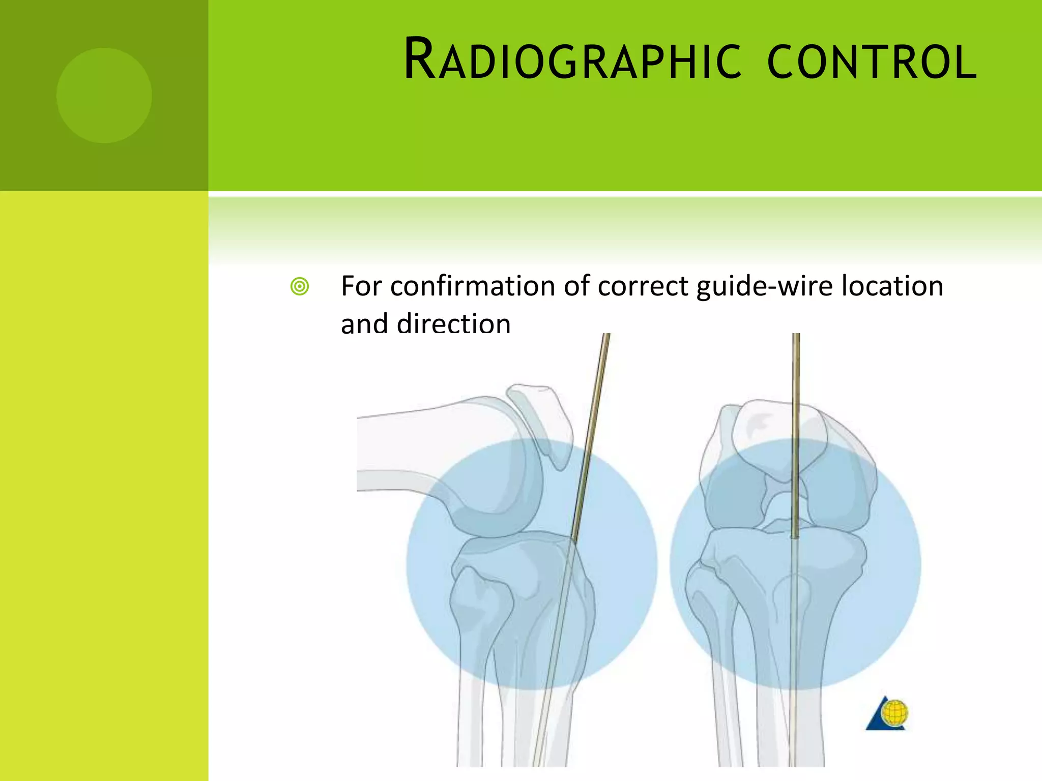 How do I do Interlocking Tibia.pptx
