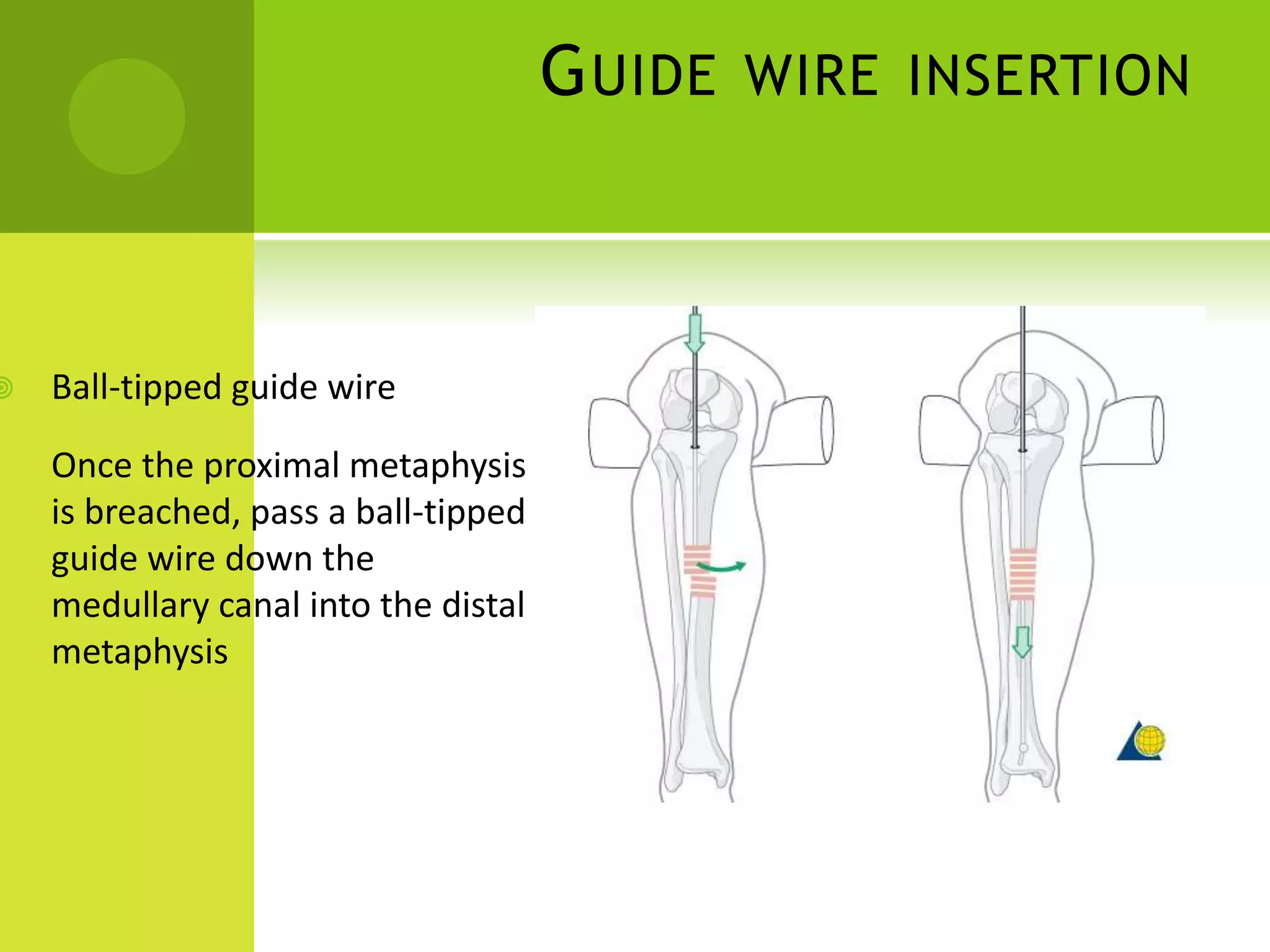 How do I do Interlocking Tibia.pptx