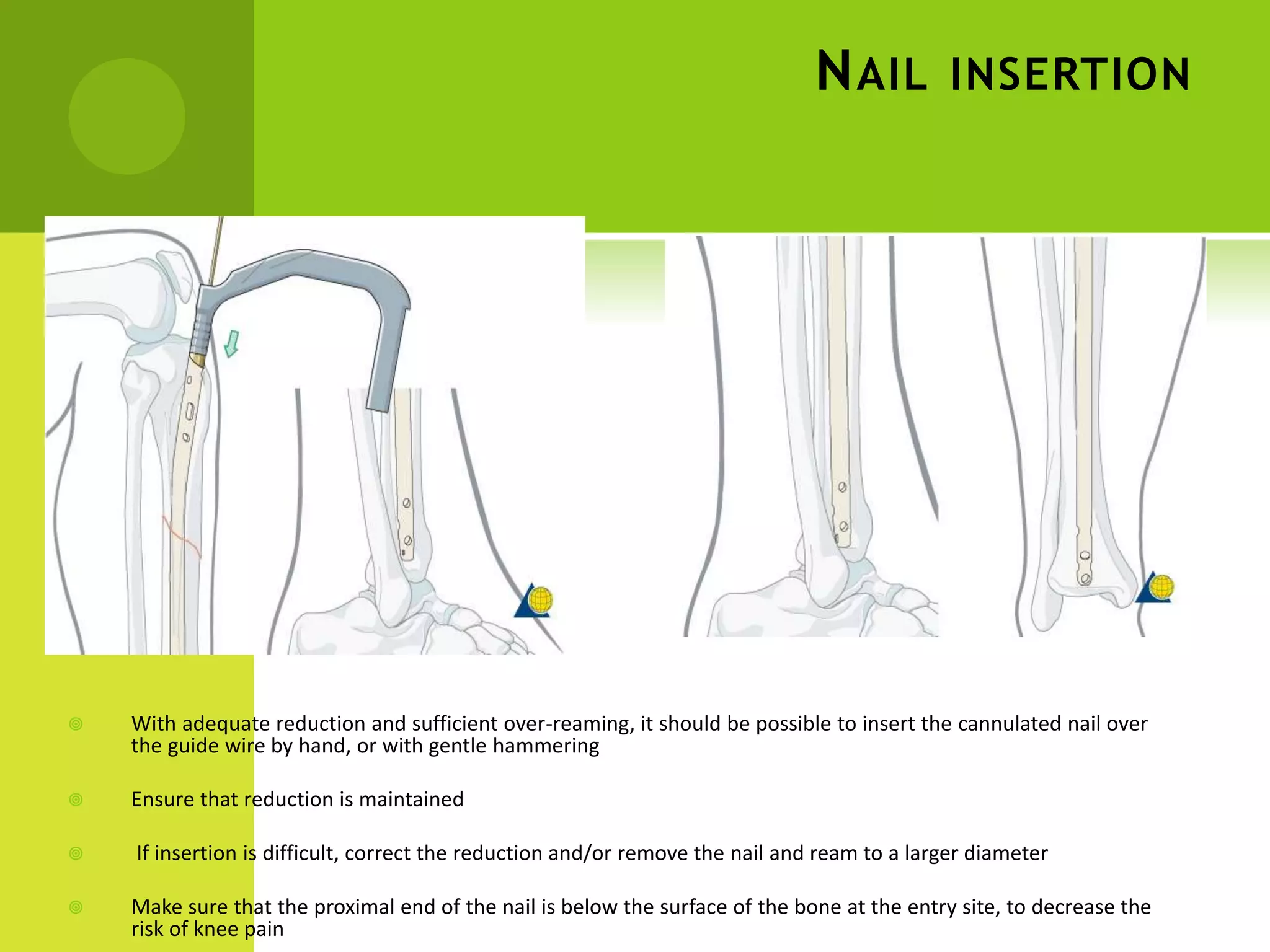 How do I do Interlocking Tibia.pptx