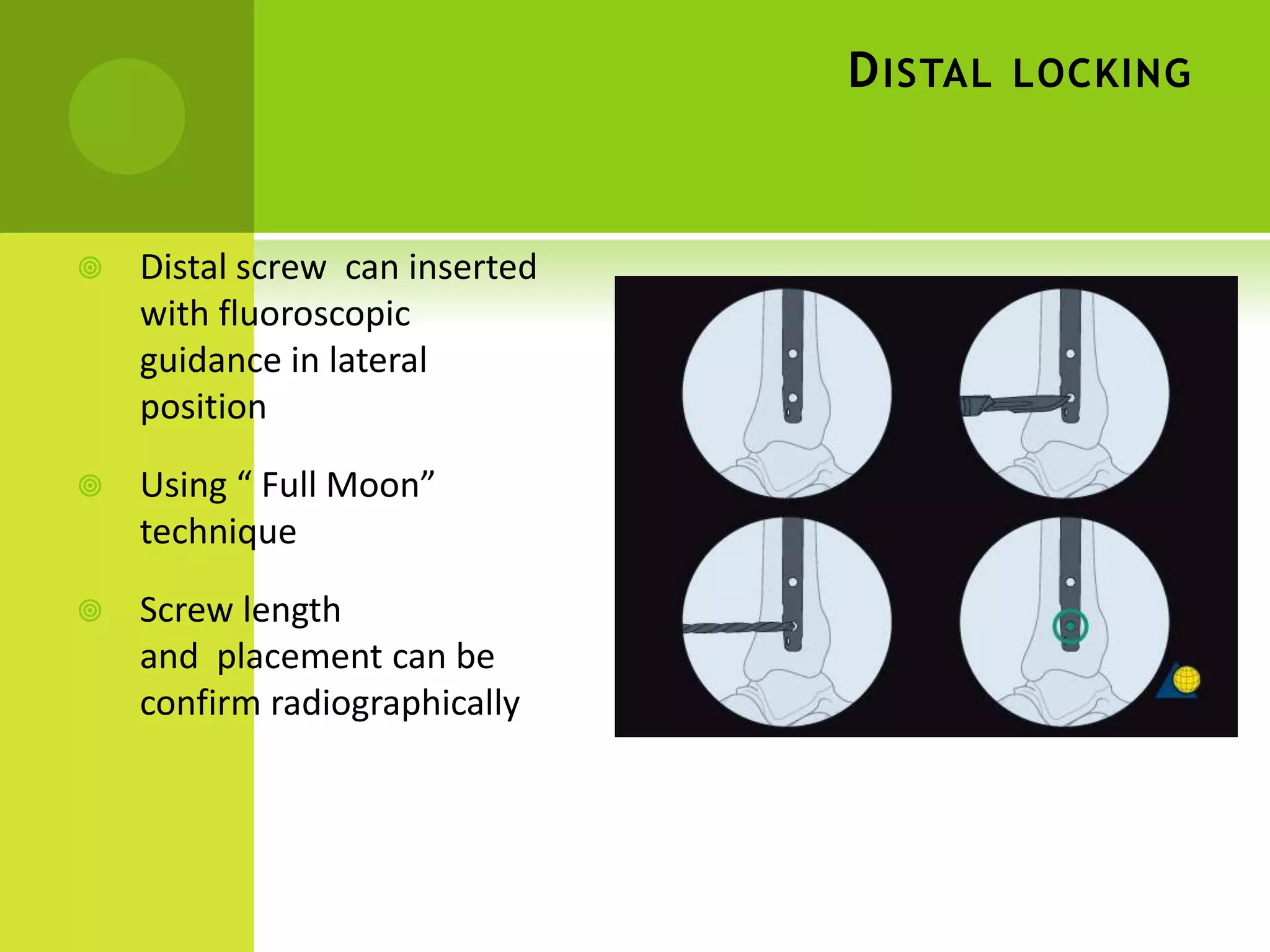 How do I do Interlocking Tibia.pptx