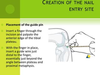 How do I do Interlocking Tibia.pptx