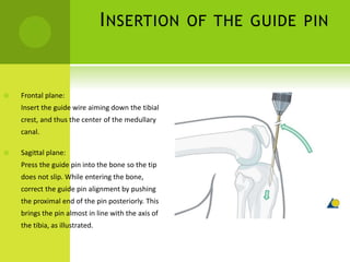 How do I do Interlocking Tibia.pptx