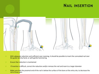 How do I do Interlocking Tibia.pptx