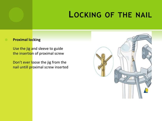 How do I do Interlocking Tibia.pptx