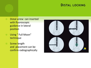 How do I do Interlocking Tibia.pptx