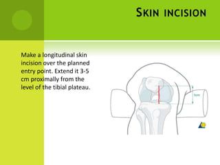 How do I do Interlocking Tibia.pptx