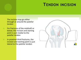 How do I do Interlocking Tibia.pptx