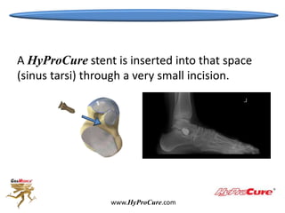 An Introduction to HyProCure | PPTX