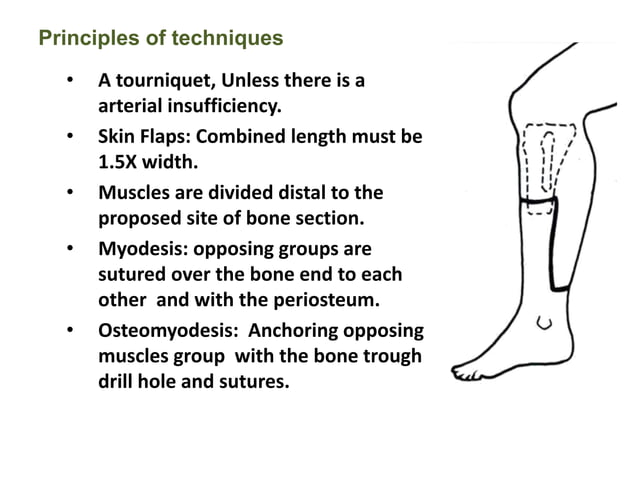 How i do below knee amputation