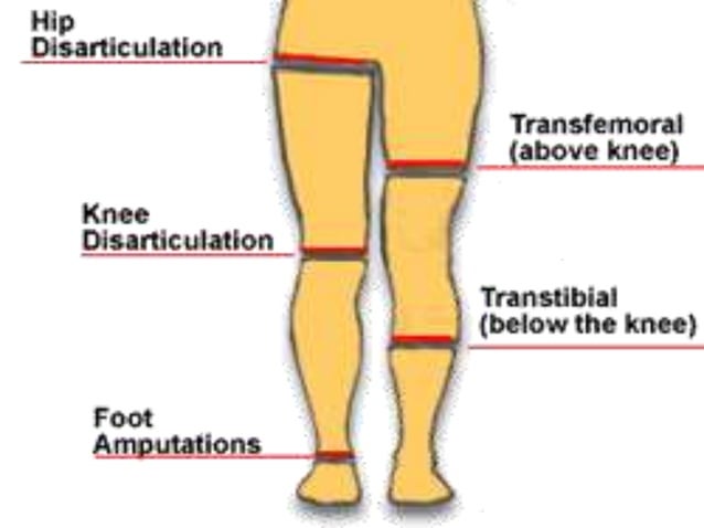 How i do below knee amputation