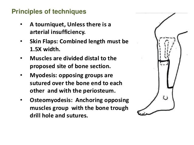 Below Knee Amputation Anatomy