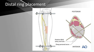 How I do Ilizarov Tibia.pptx