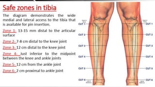 How I do Ilizarov Tibia.pptx