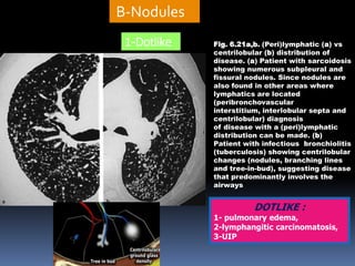 How read chest ct 3 | PPSX