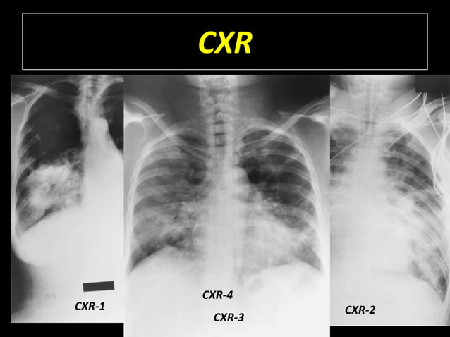 How read chest xr 13 | PPT