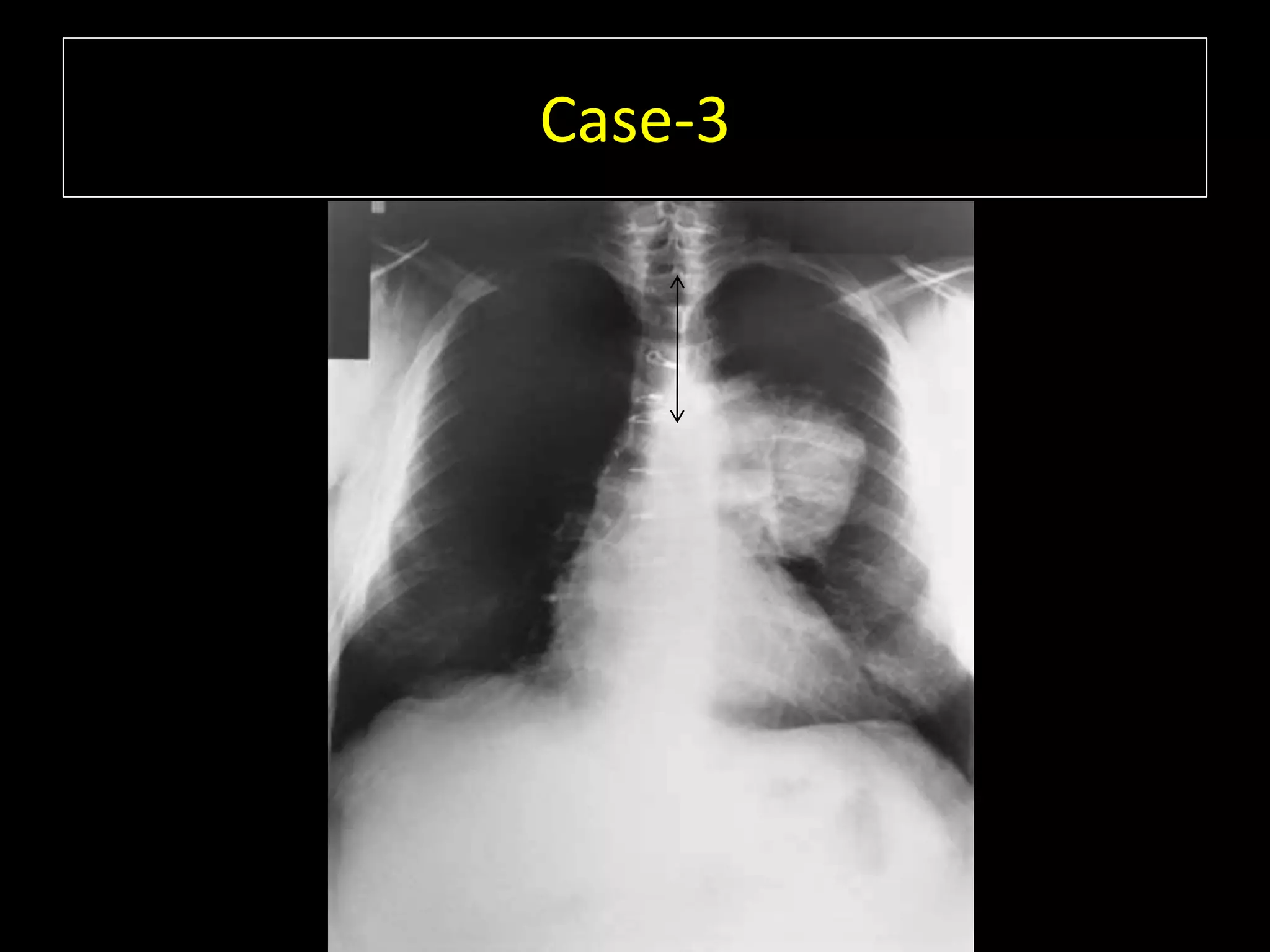 How read chest xr 8 | PPSX