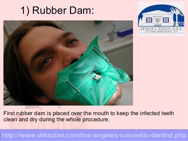 How Root Canal Therapy Works