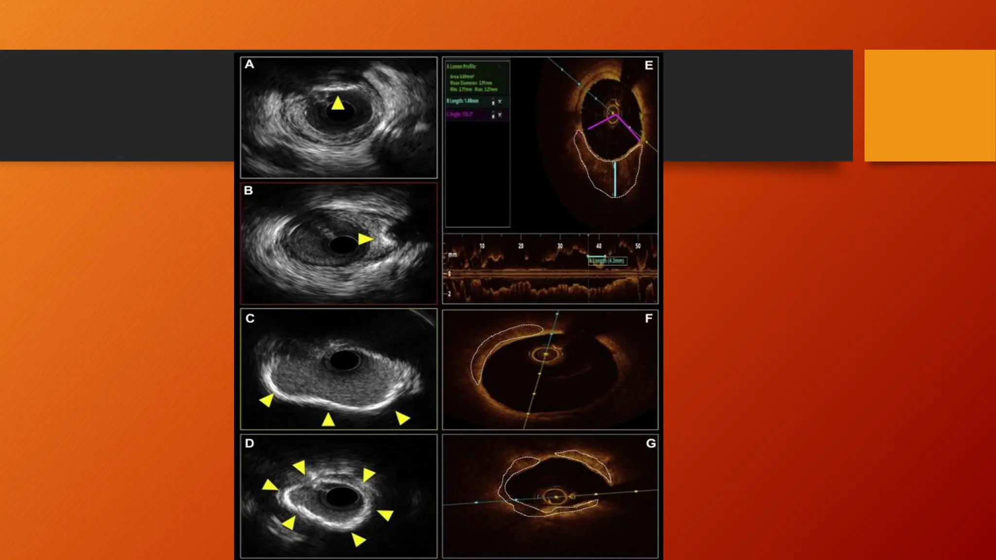 How should we treatHOW TO TREAT DENSELY CALCIFIED LESIONS ATHERECTOMY ...