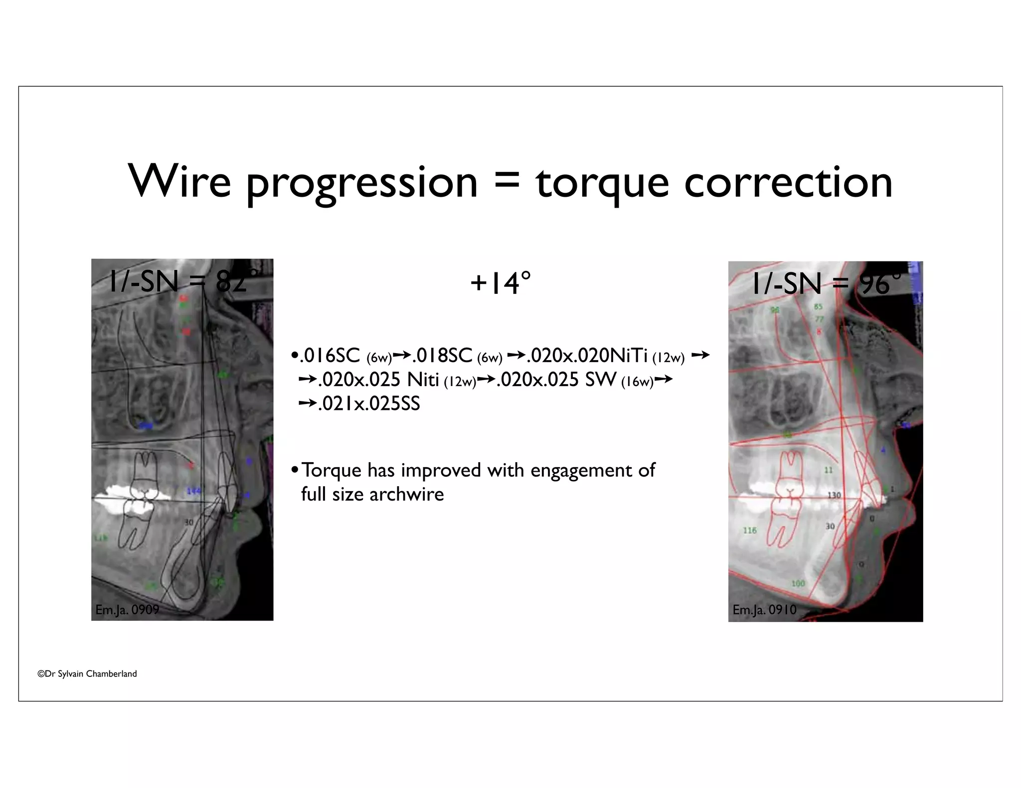 How SPEED Appliance is Effective in Torque Control, Space Closure and ...