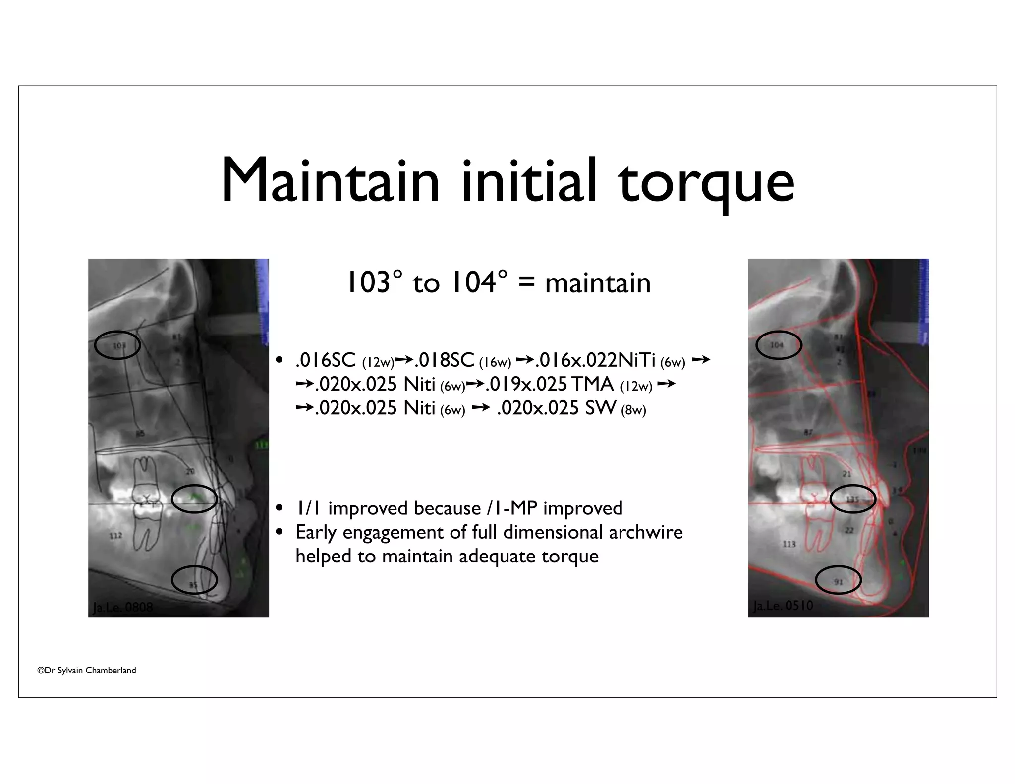 How SPEED Appliance is Effective in Torque Control, Space Closure and ...
