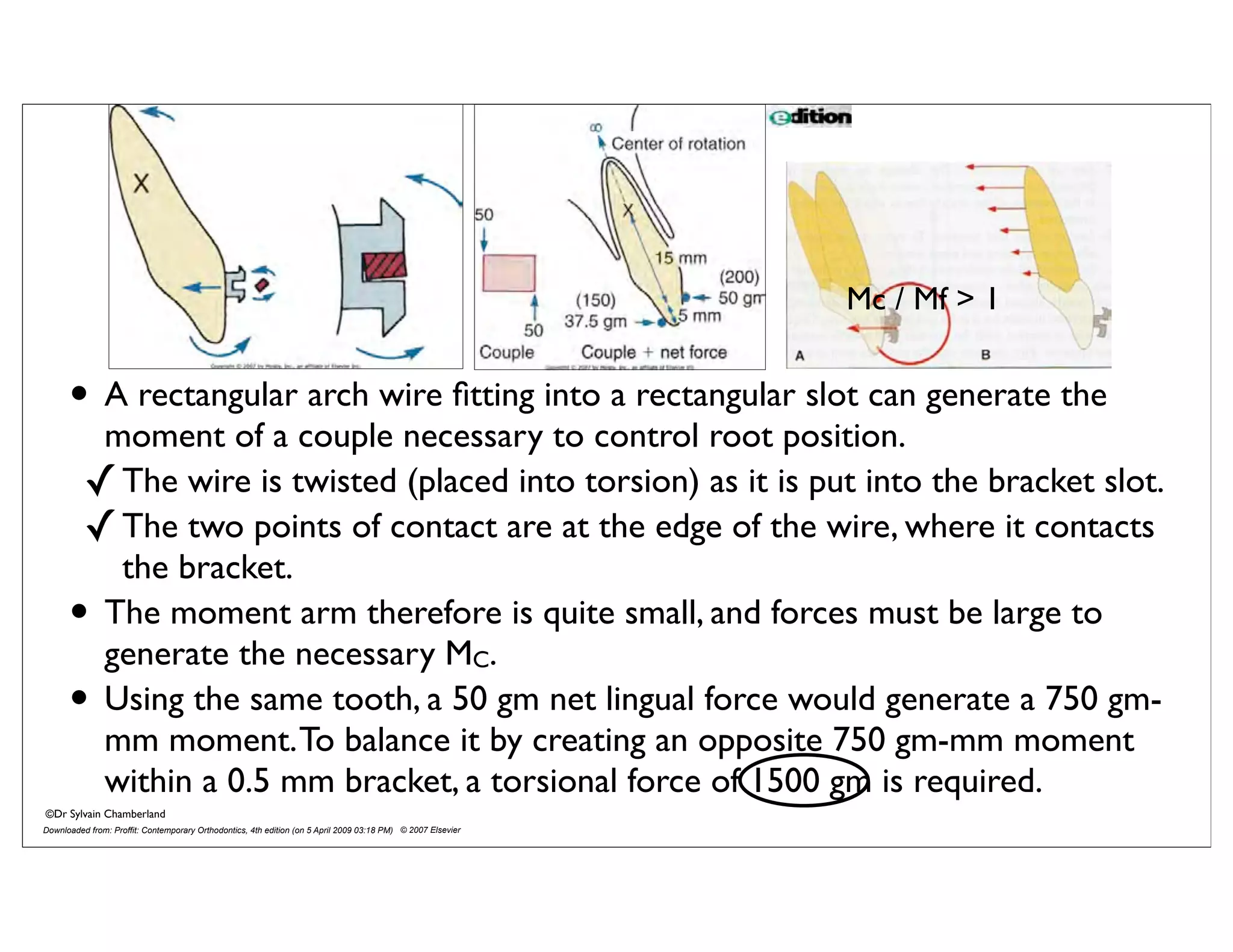 How SPEED Appliance is Effective in Torque Control, Space Closure and ...