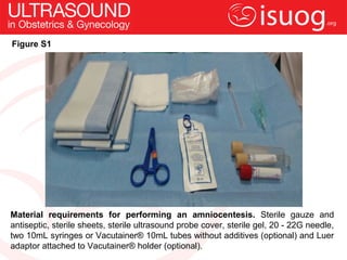 How to perform an amniocentesis | PPT | Pregnancy | Reproductive Health