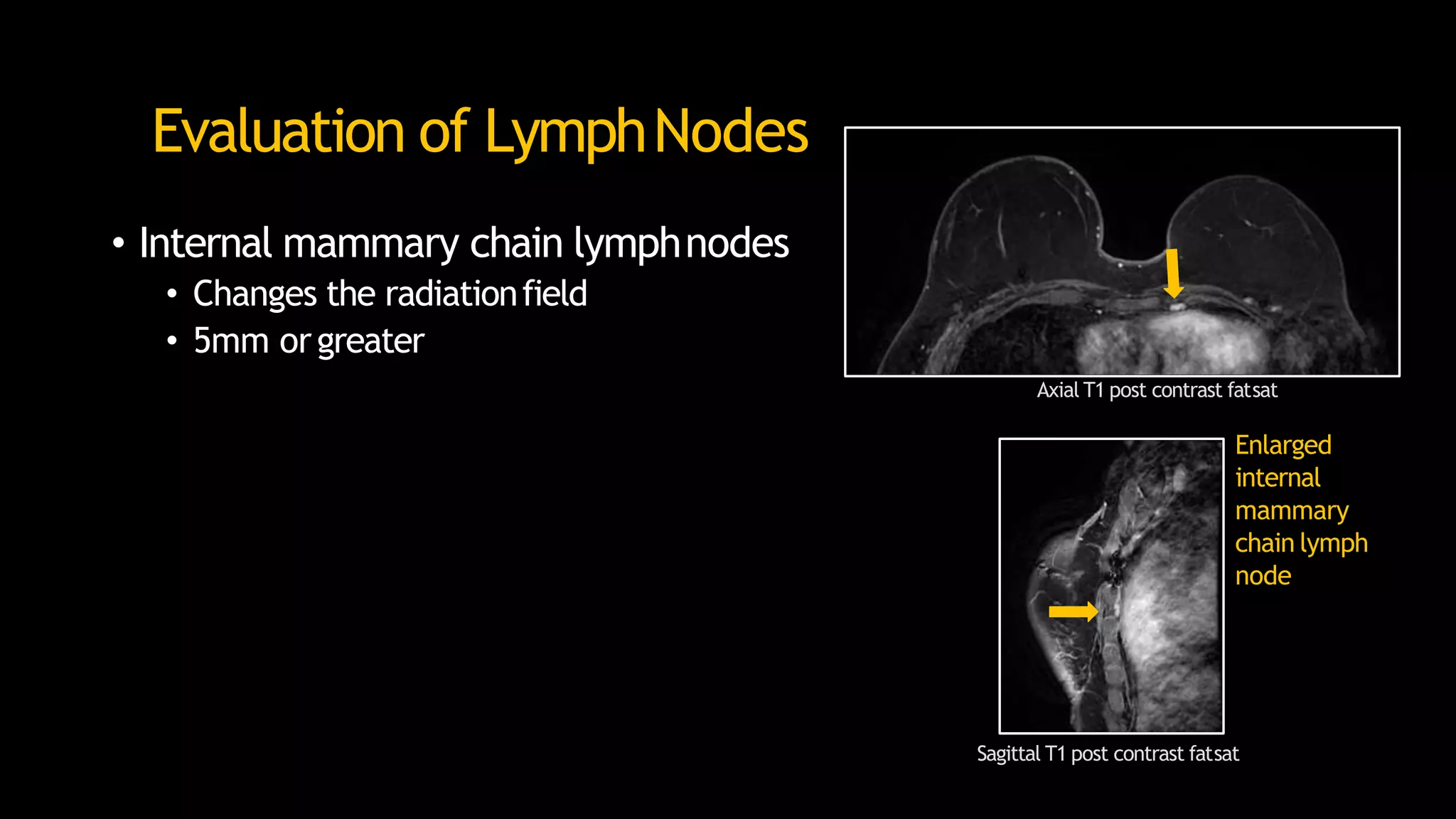 How to approch breast mri converted | PPTX
