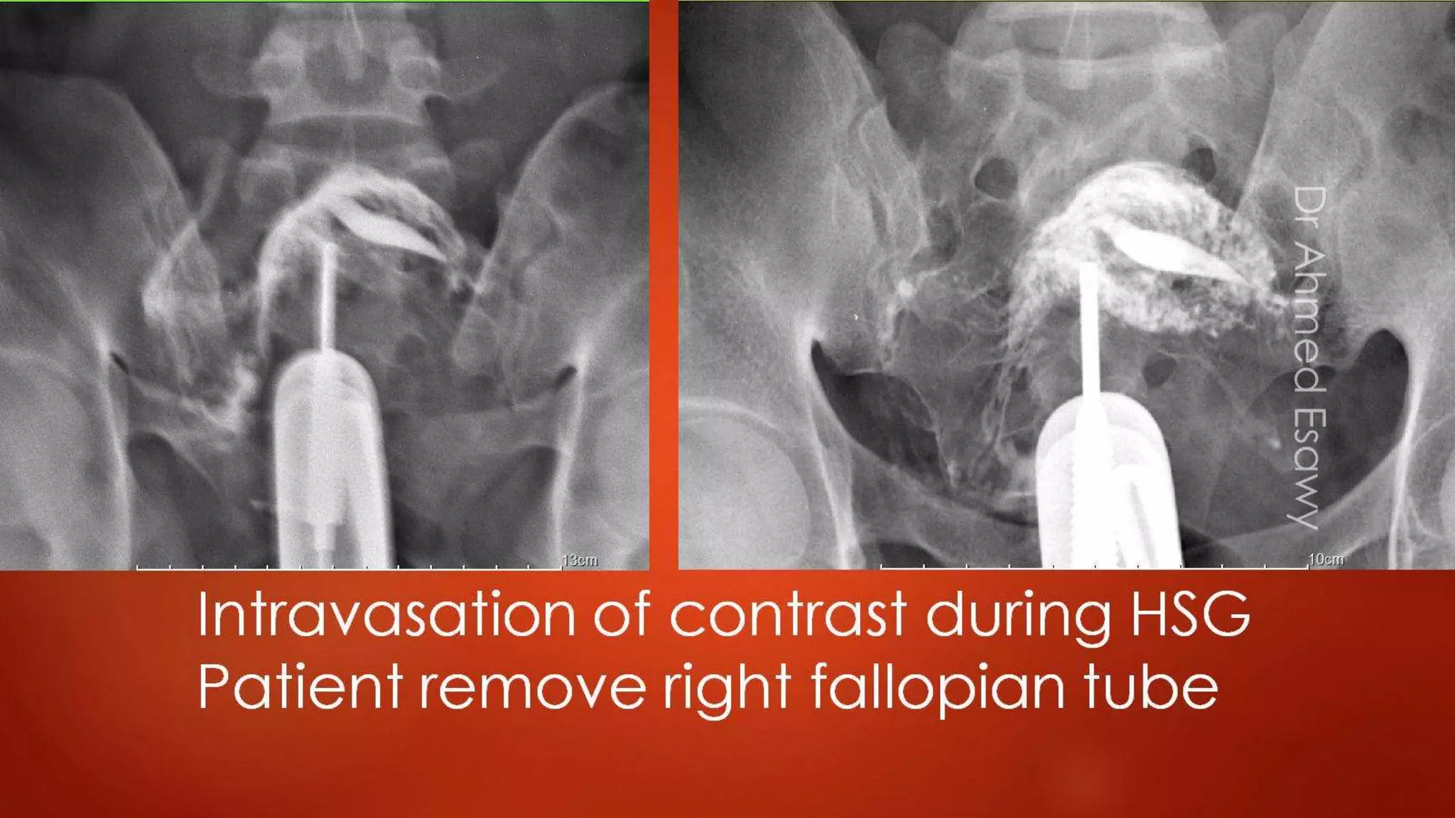How to avoid contrast venous lymphatic reflux in HSG | PPTX