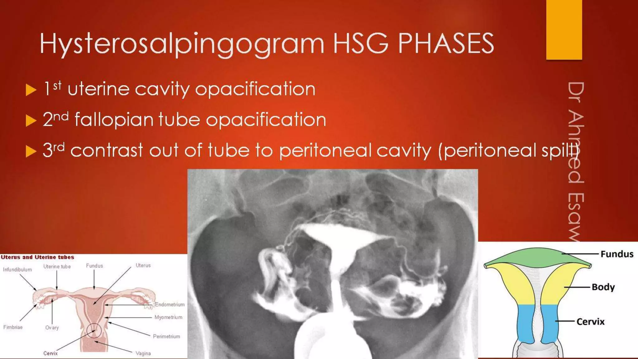 How to avoid contrast venous lymphatic reflux in HSG | PPTX