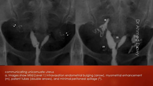 How to avoid contrast venous lymphatic reflux in HSG | PPT