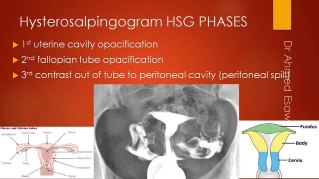 How to avoid contrast venous lymphatic reflux in HSG | PPTX