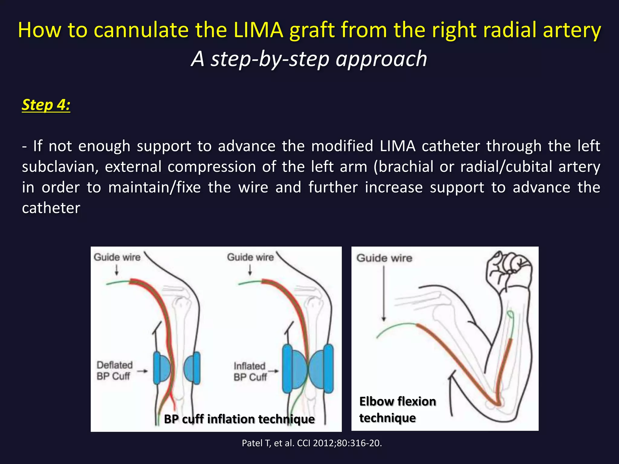 Bagur R - AIMRADIAL 2014 Technical - Cannulate the LIMA | PPTX