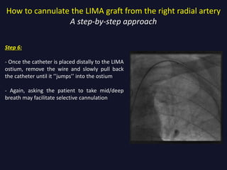 Bagur R - AIMRADIAL 2014 Technical - Cannulate the LIMA | PPTX