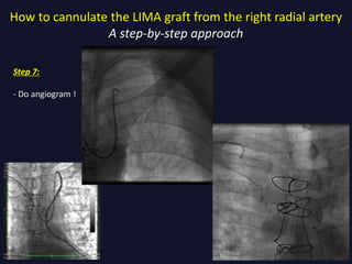 Bagur R - AIMRADIAL 2014 Technical - Cannulate the LIMA | PPTX