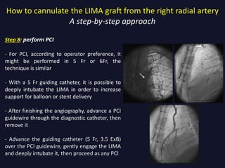 Bagur R - AIMRADIAL 2014 Technical - Cannulate the LIMA | PPTX