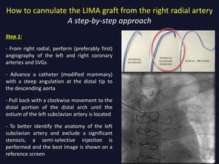 Bagur R - AIMRADIAL 2014 Technical - Cannulate the LIMA | PPTX